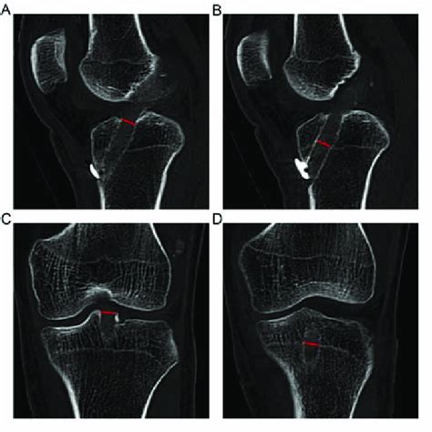 The Measurement Of The Tibial Tunnel Diameter A Plateau On The