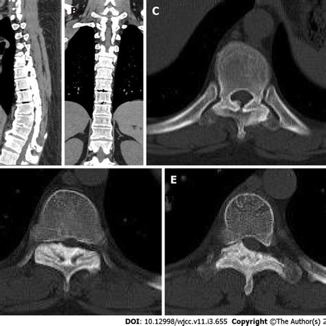 Thoracic Computed Tomography Before Treatment A And B A Computed Download Scientific Diagram