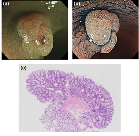 Japan Narrow Band Imaging Nbi Expert Team Jnet Classification Of Download Scientific