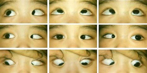 Clinical Types Of Ocular Deviation Optography