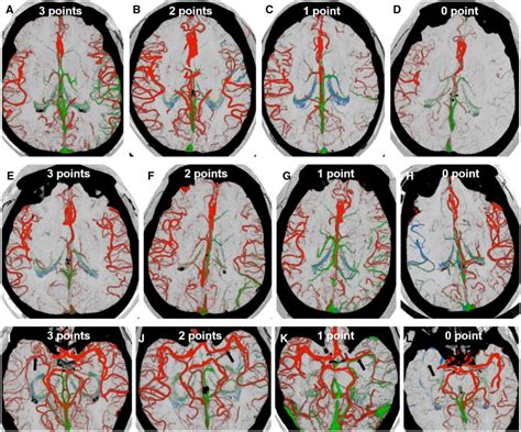 Colour Coded Collateral And Venous Outflow Patterns In Estimating