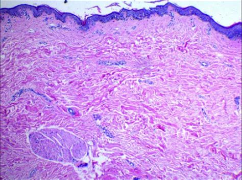 Dermoscopic Patterns In Lichen Sclerosus A Report Of Three Cases Pmc