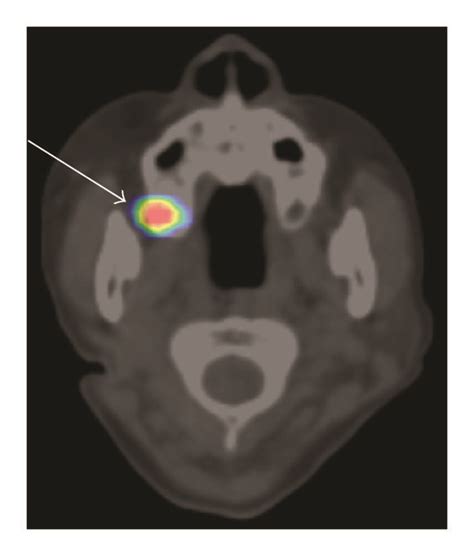 A ¹⁸f Fdg Petct Image Remarkable Abnormal Fdg Uptake By The Lymph