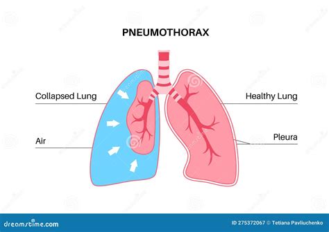 Pneumothorax Anatomical Poster Vector Illustration 275372110