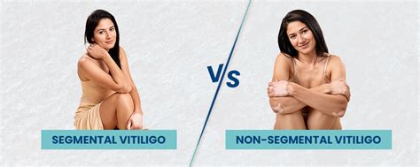 Non Segmental Vs Segmental Vitiligo Which One Do You Have