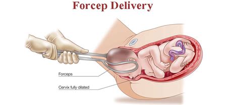 Types Of Forceps Delivery