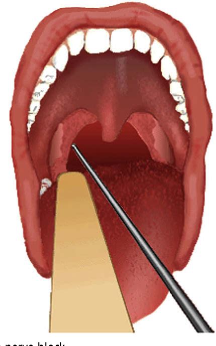 Glossopharyngeal Nerve Block