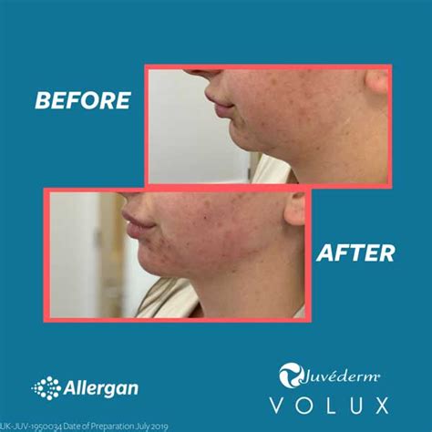 Dermal Fillers Somerset Cosmetic Clinic
