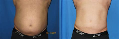 Liposuction Abdomen Flanks Before And After Photo Gallery Coeur D