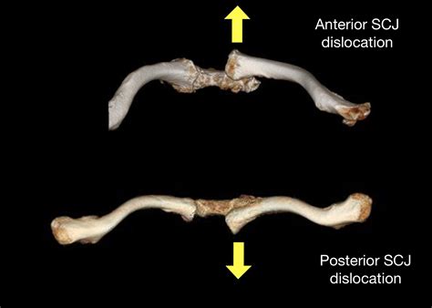 Sternoclavicular Joint Injuries When To Consider Surgery And How Is It Done Safely Shoulder