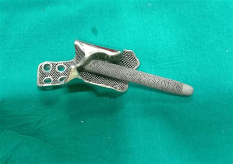 Custom Tibia Implant For Complex Tibial Reconstruction Jajal Medical Service