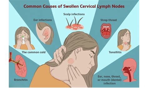Eczema On Scalp And Swollen Lymph Nodes At William Pfeffer Blog
