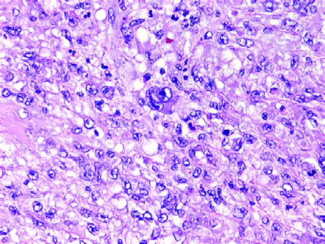 Pathology Outlines Myxoinflammatory Fibroblastic Sarcoma