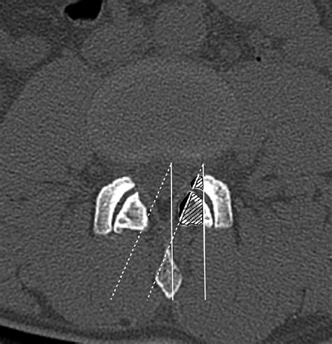 Comparison Between Contralateral Right Dotted Line And Ipsilateral Download Scientific
