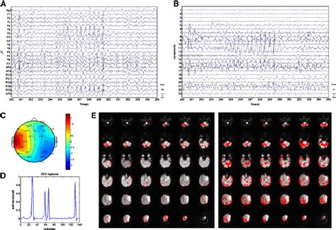 Patient 1 A EEG Signal After Pre Processing B EEG Components Download Scientific Diagram