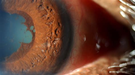 Multidisciplinary Partnerships In The Management Of Uveitis In Patients