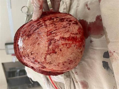 Scalp Angiosarcoma A Case Report Asian Journal Of Plastic And