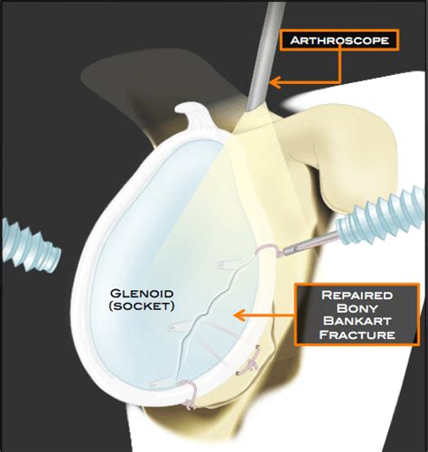 Bankart Lesion