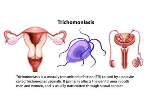Signs Of Trichomoniasis Discharge
