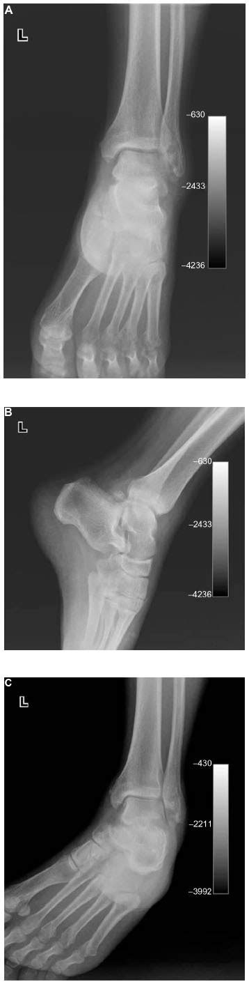 Closed Anterolateral Total Talar Dislocation A Case Report And Techni Orr