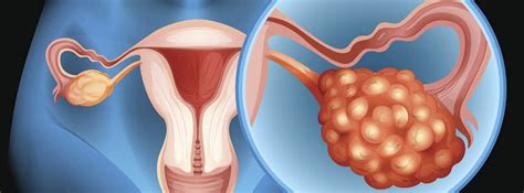 Cáncer De Ovario Síntomas Y Causas Canalsalud