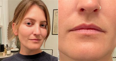 I Tried Cheek Filler See Before And After Photos Popsugar Beauty