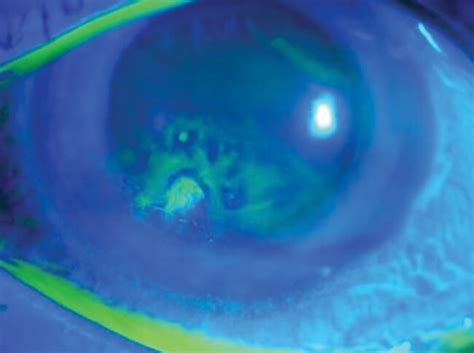 Punctate Epithelial Erosion