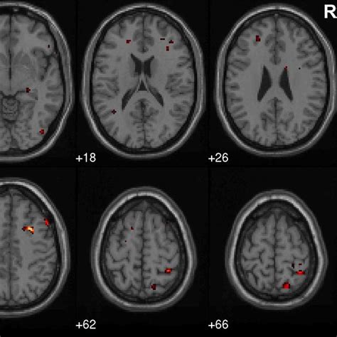 spatial parametric bold activation maps for mr condition contrast