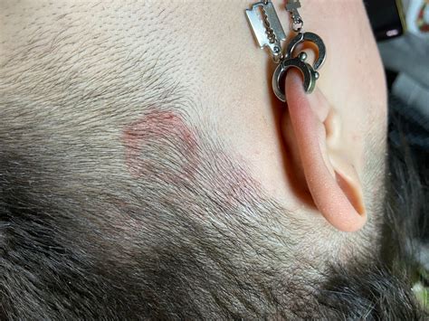 Красные шелушащиеся высыпания по кромке волос Вопрос дерматологу 03 Онлайн