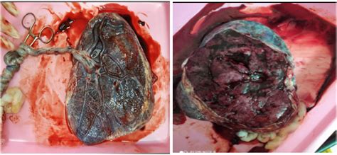 Gross Specimen Pictures Of Placenta Download Scientific Diagram