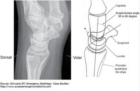 Scapholunate Dislocation