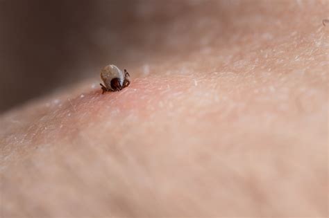 인간의 피부에 진드기 매크로 사진을 빠는 익소드 리시누스 부풀어 오른 기생충은 분홍색 자극표에 물린다 작은 빨간 방울 위험한