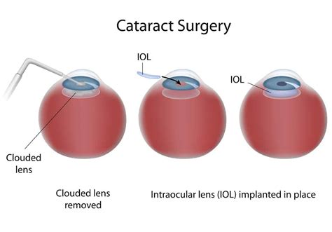Which Intraocular Lens Is Right For You Los Angles And Orange County