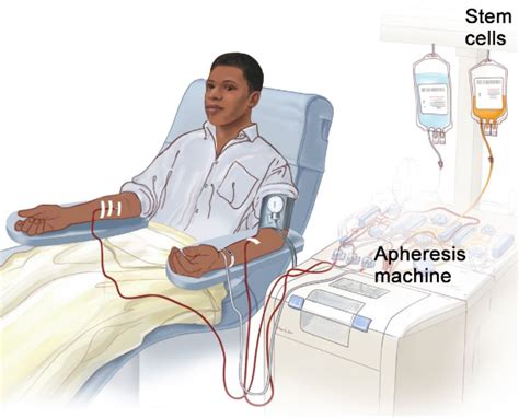 Motixafortide May Improve Stem Cell Transplants For People With