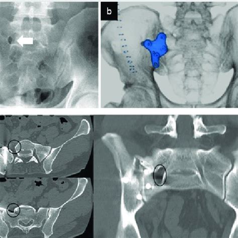 Pdf Pitfalls During Sacroiliac Joint Arthrodesis For Patients With Severe Sacroiliac Joint