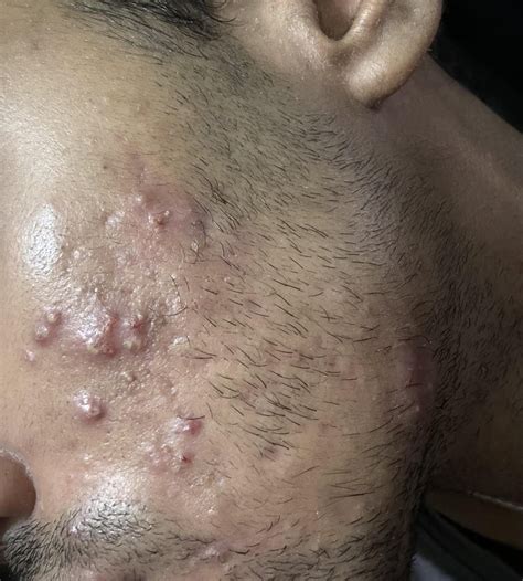 Is This Purging Raccutane