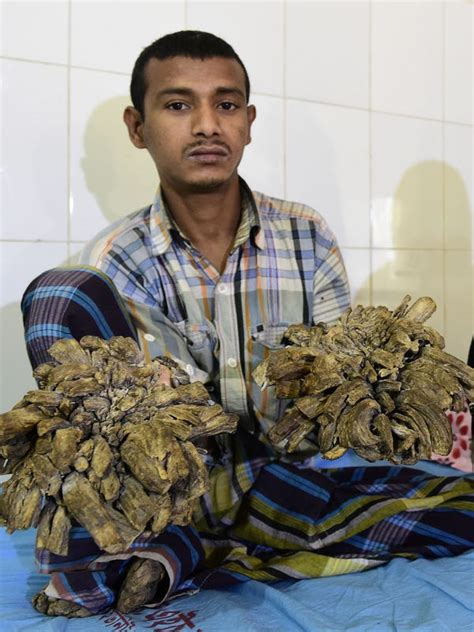 Rare Tree Man Disease May Have Struck First Female