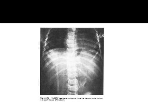 Ossification And Calcification Pptx Bone And Joint Conditions Diseases And Conditions