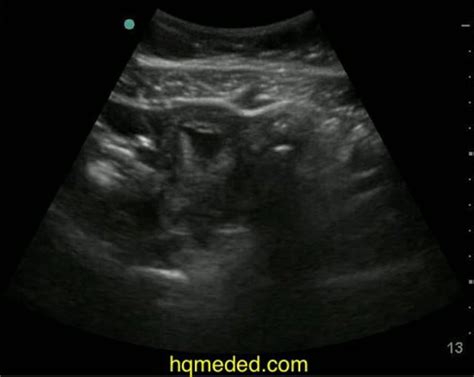 Ultrasonography Subchorionic Bleed On Vimeo
