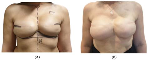 Treatment Of Capsular Contracture In Previously Irradiated Breasts