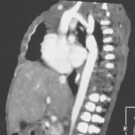 2d Reconstruction Showing Hypoplastic Aortic Arch Arrowheads With Download Scientific Diagram