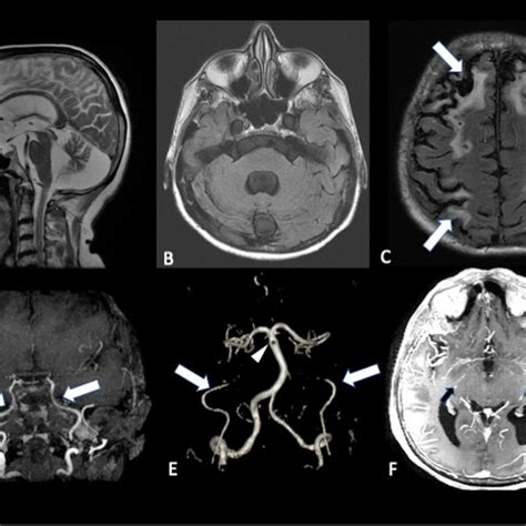 Sagittal T2 A And Axial Flair B Images Showing Cerebellar Atrophy Download Scientific