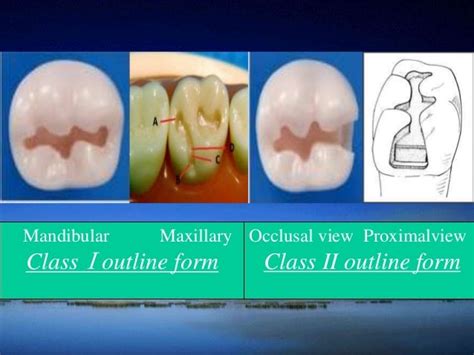 Principles Of Cavity Preparation By Dr Rupali