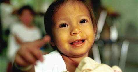 Más De 2500 Niños Nacen Con Labio Leporino En Perú Cada Año Clínica San Pablo Lanza Campaña De