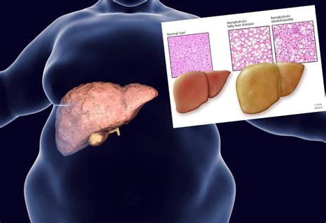 အသည်း အဆီဖုံးခြင်း ရောဂါအကြောင်း သိကောင်းစရာ Positive Angle News