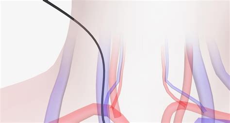 Premium Photo Right Heart Catheterization Involves A Catheter That Is