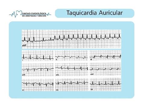 Enfermer En Urgencias Y Uci Manejo De Las Arritmias Perioperatorias I