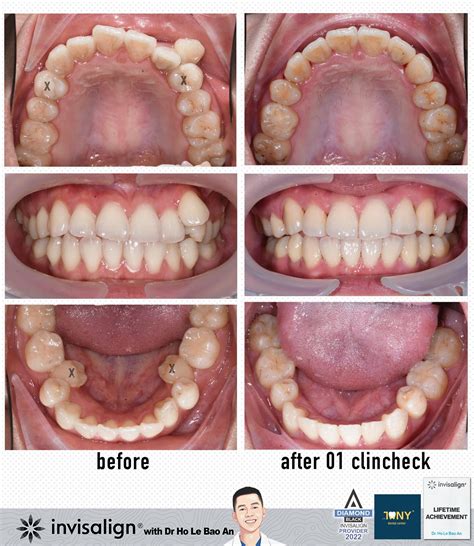 Niềng Răng Trong Suốt Invisalign