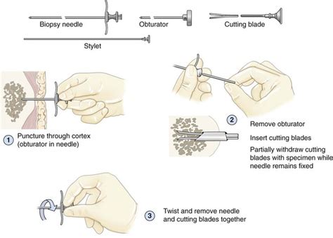 Bone Marrow Examination Oncohema Key