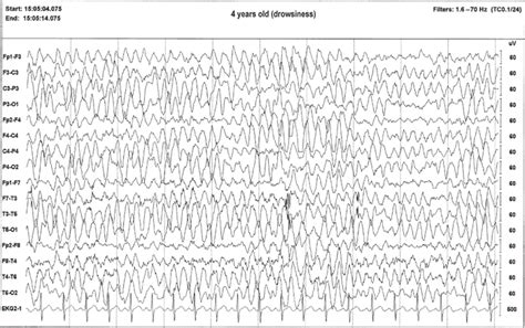 Eeg Fun Facts Hypnagogic Hypersynchrony Mar 24 2023